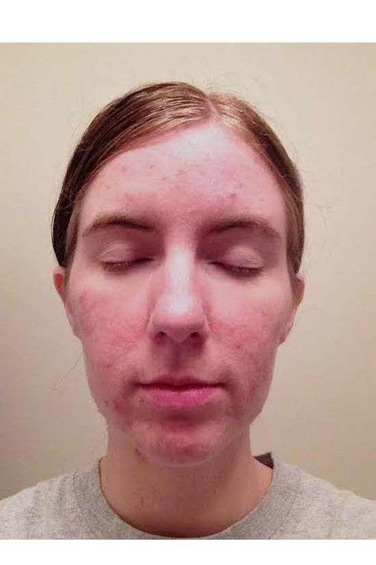 Rosacea and LEROSETT® Testimony - Gunilla of Sweden® Skincare